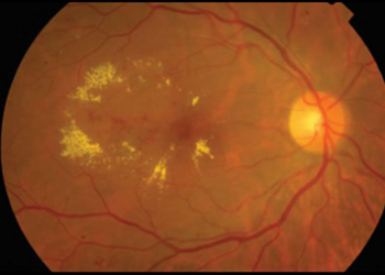 Arquivos edema macular - Universo Visual