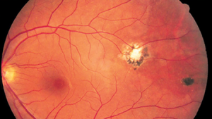 Oftalmologia - Toxoplasmose ocular pode comprometer gravemente a visão ...