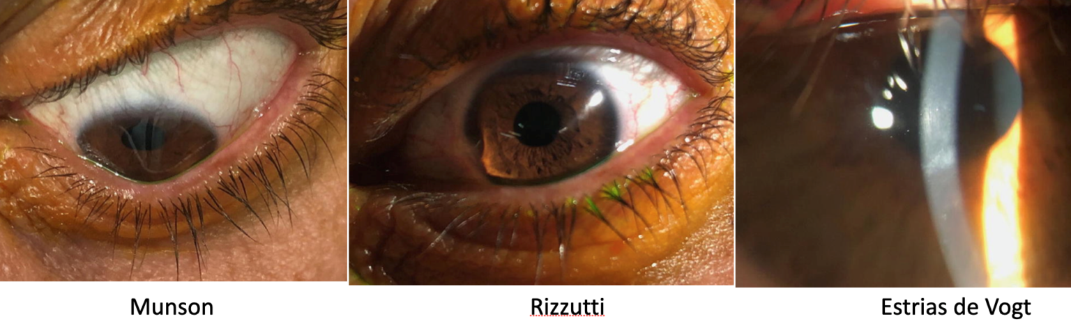 Oftalmologia - Principais aspectos no diagnóstico do Ceratocone - Universo Visual