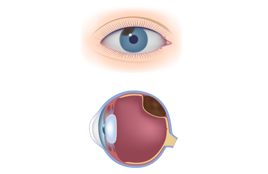 Oftalmologia - Melanoma uveal: desvendando os mecanismos da metástase ...